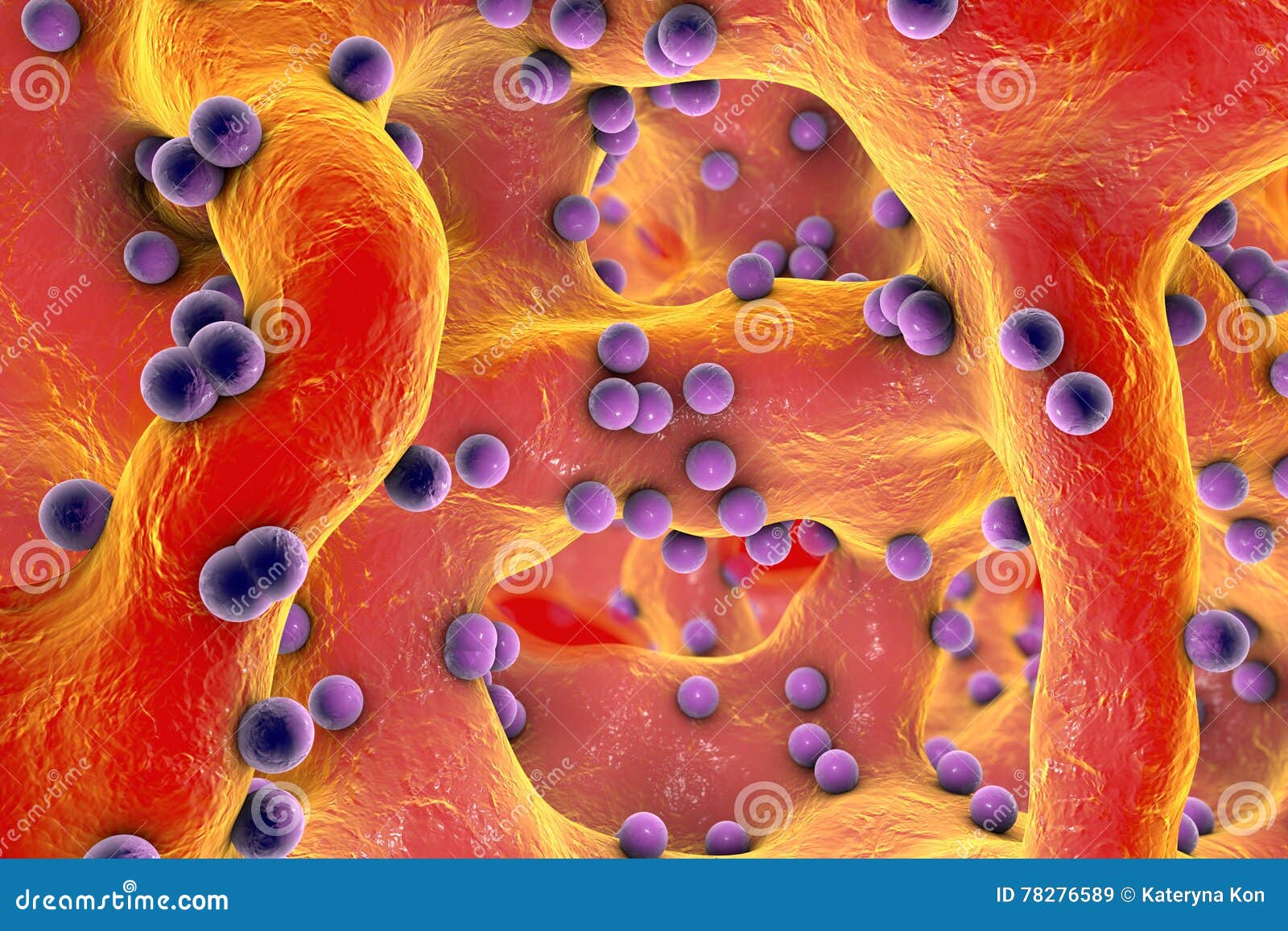 Osteomyelitis Is Infection In The Bone. Close-up Bacteria ...