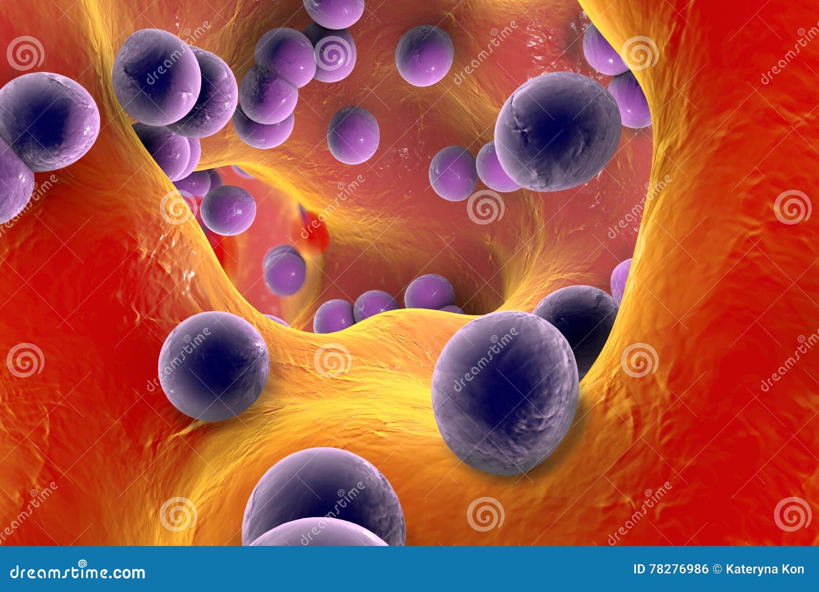 Spherical Bacteria Inside Bone Tissue Stock Illustration - Illustration ...