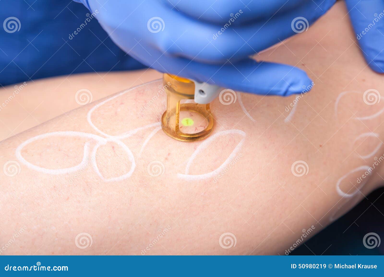Spider vein medical laser stock image. Image of veins - 50980219