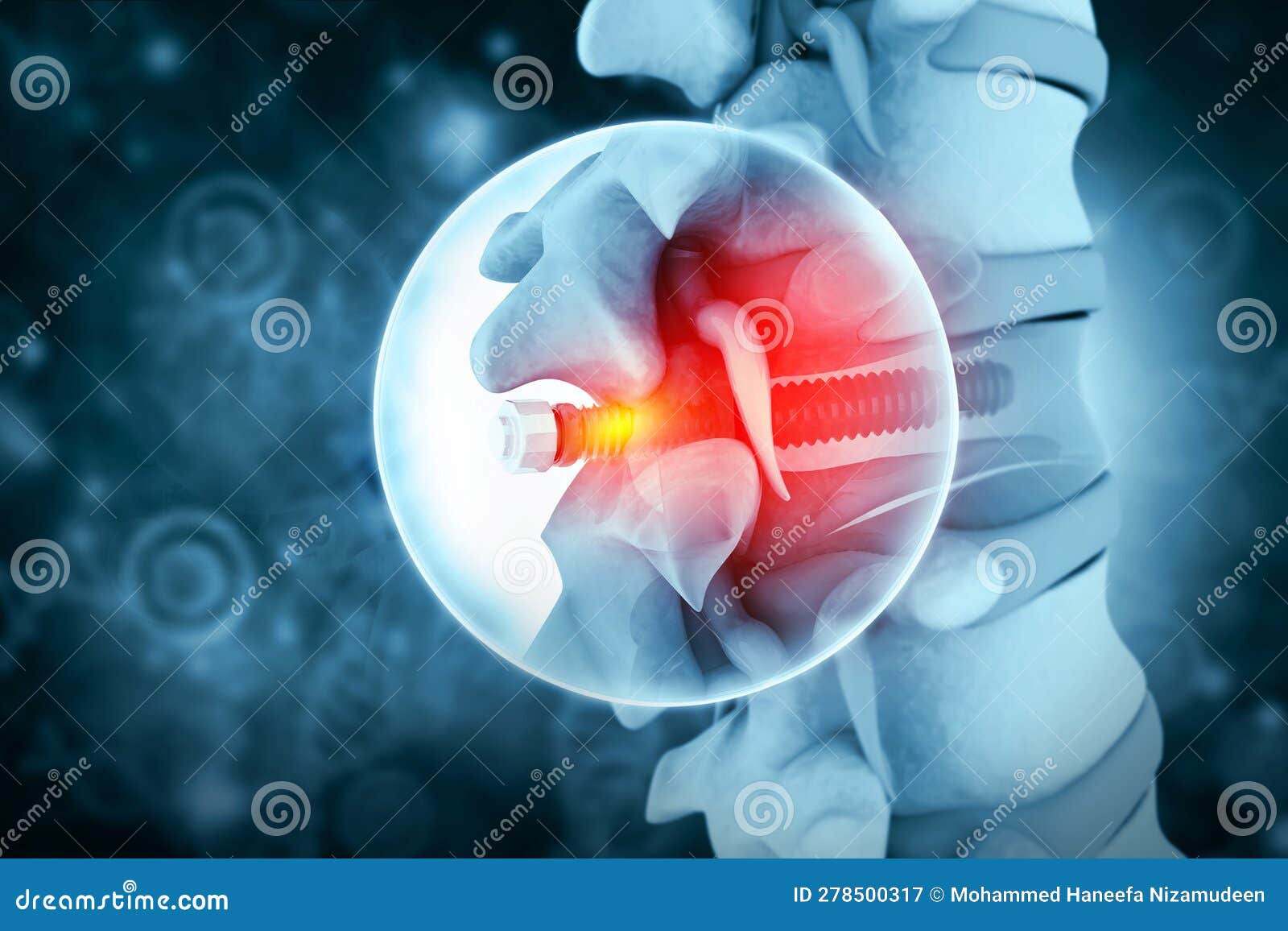 Spinal Column with Implant, Placement Stock Illustration - Illustration ...