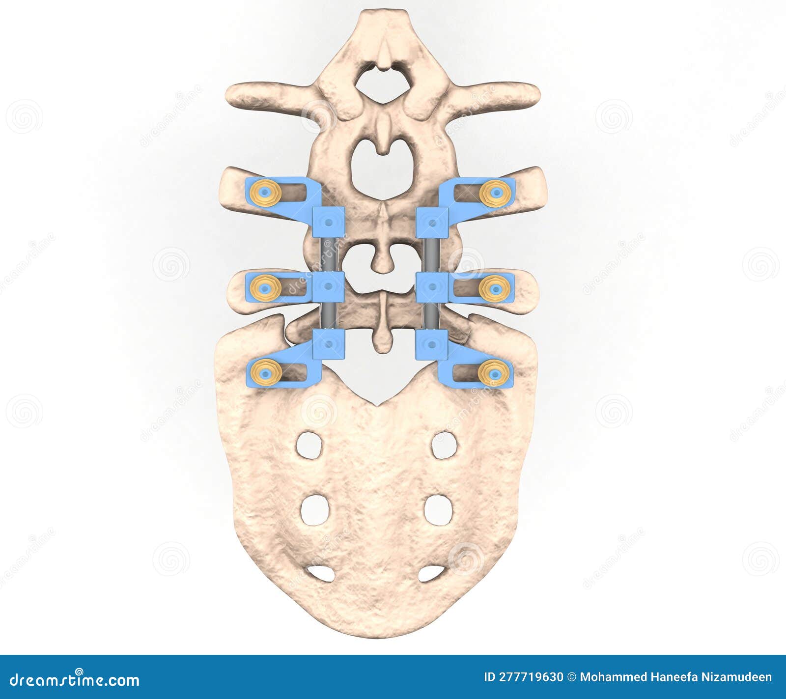 Spinal Column with Implant, Placement Stock Illustration - Illustration ...