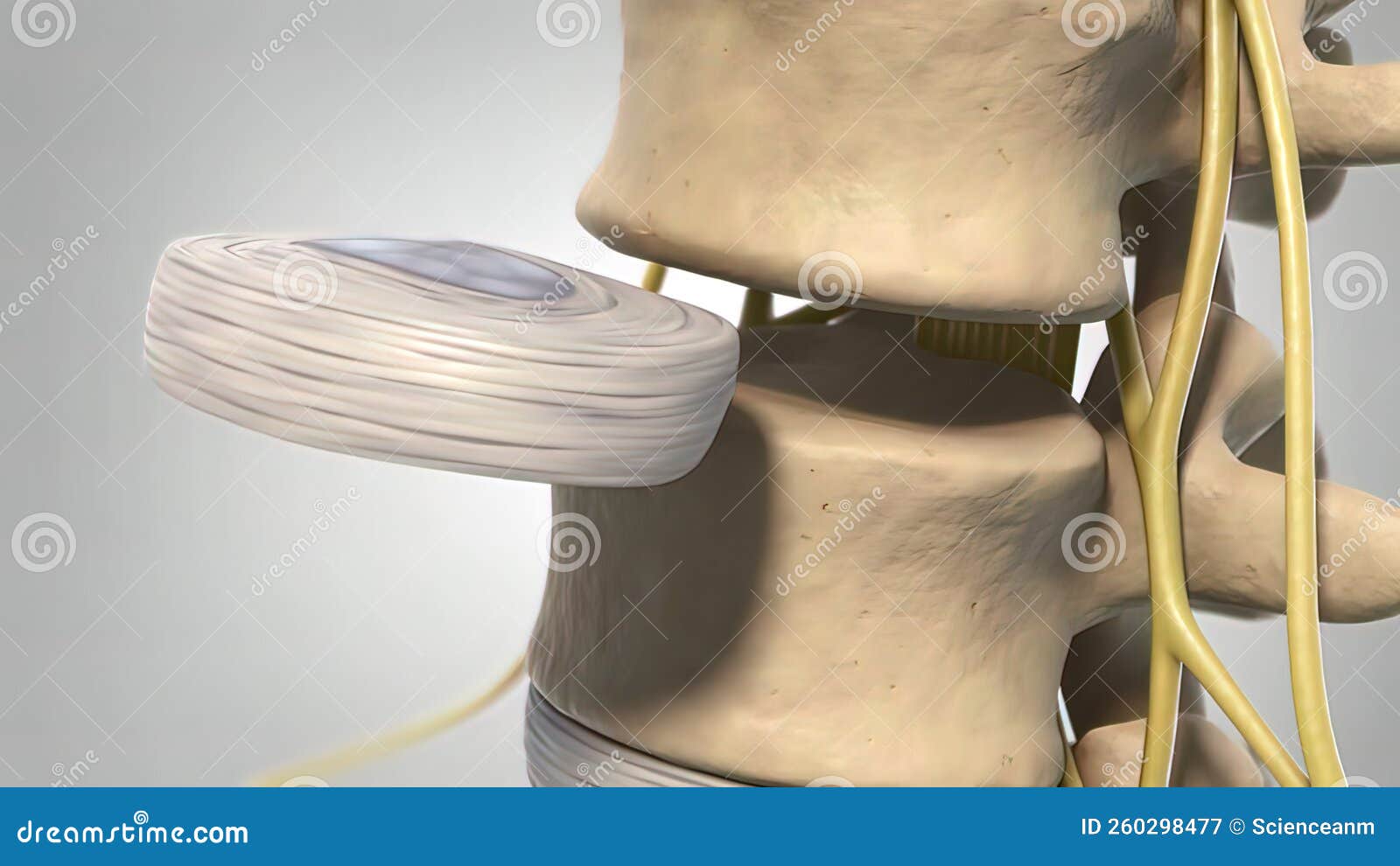 Spinal Cord Disc Crack 3d Medical Stock Illustration - Illustration of ...