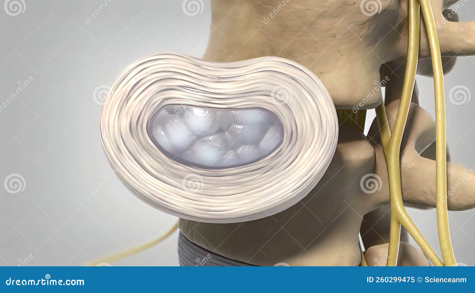 Spinal Cord Disc Crack 3d Medical Stock Illustration - Illustration of ...