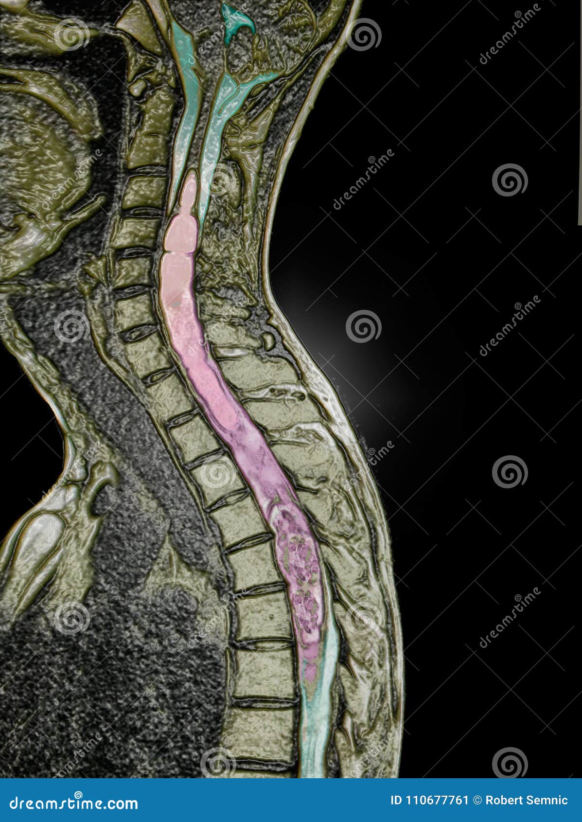 Spinal Cord Tumor, Illustration, MRI Stock Image - Image of tumor ...