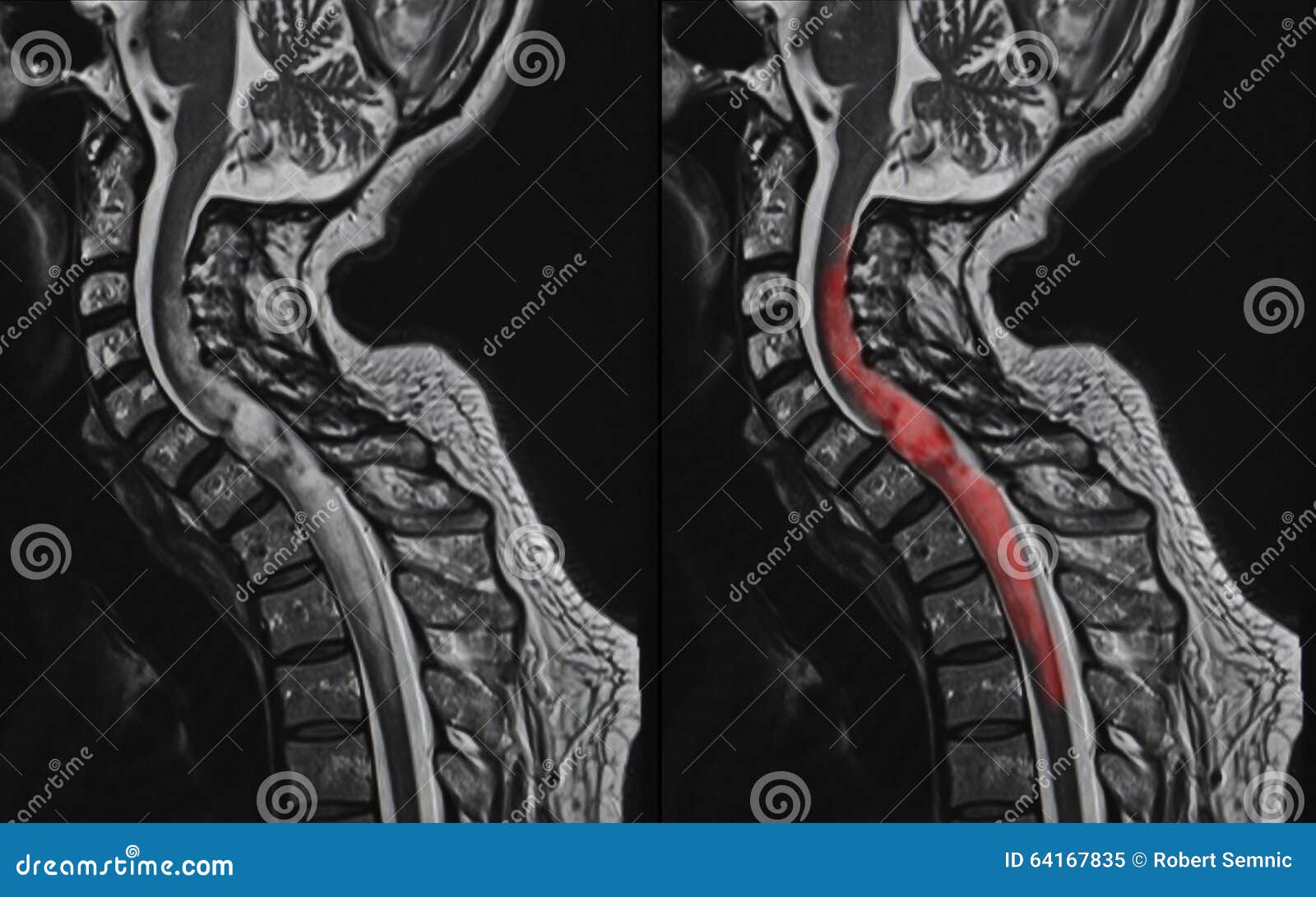 Spinal cord tumor, MRI stock image. Image of care, cord - 64167835