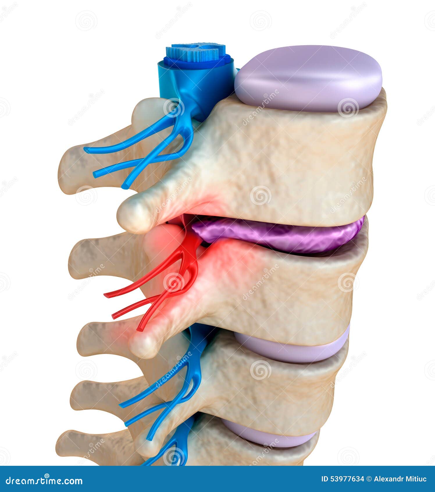Spinal Cord Under Pressure of Bulging Disc Stock Illustration ...