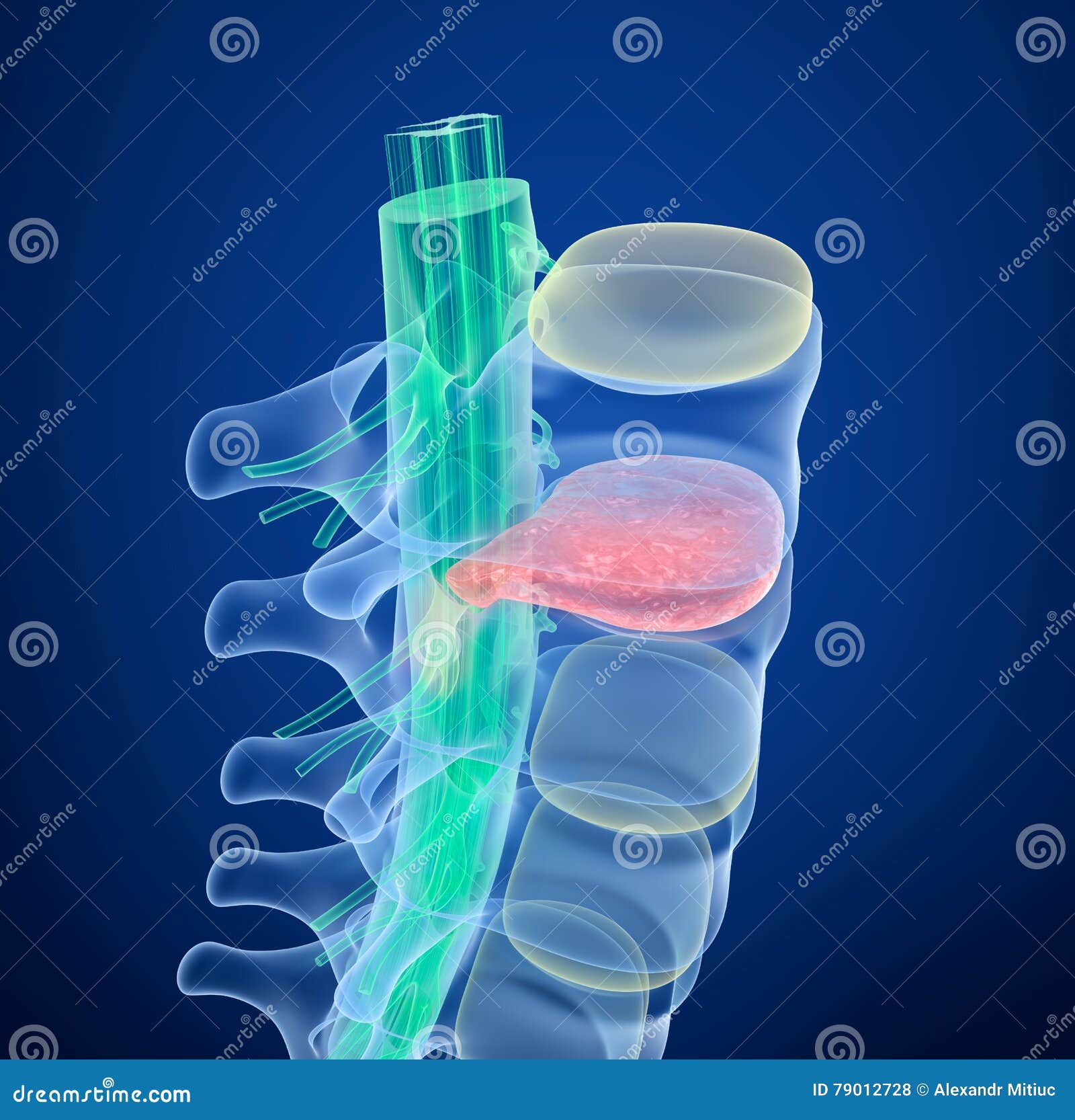 Spinal Cord Under Pressure of Bulging Disc, X-Ray View. Stock ...