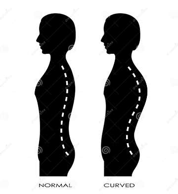 Spinal curvature stock vector. Illustration of posture - 53215486