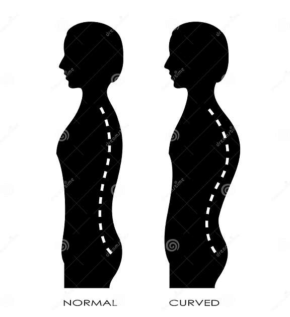 Spinal curvature stock vector. Illustration of posture - 53215486