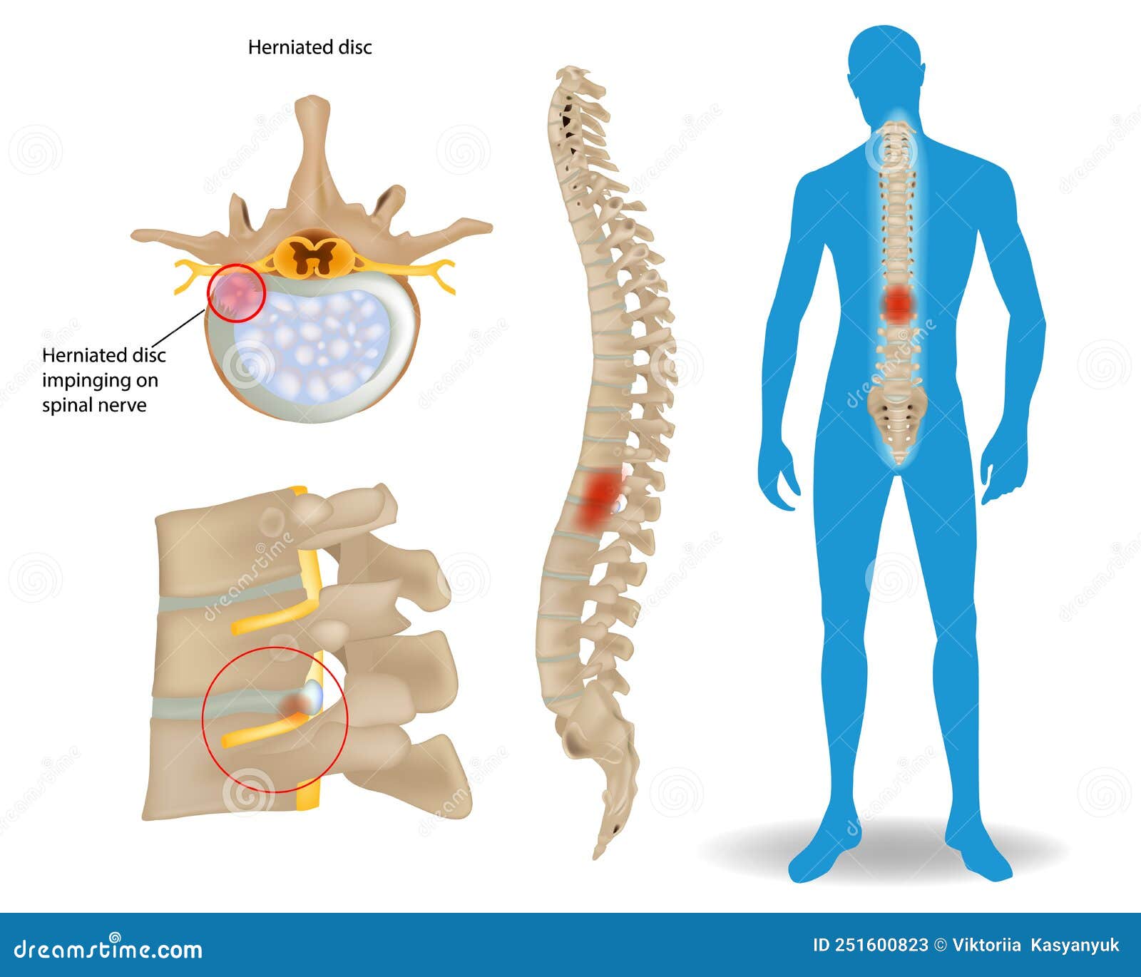 Spinal Disc Herniation. Back Pain Human. Spinal Cord Compression ...