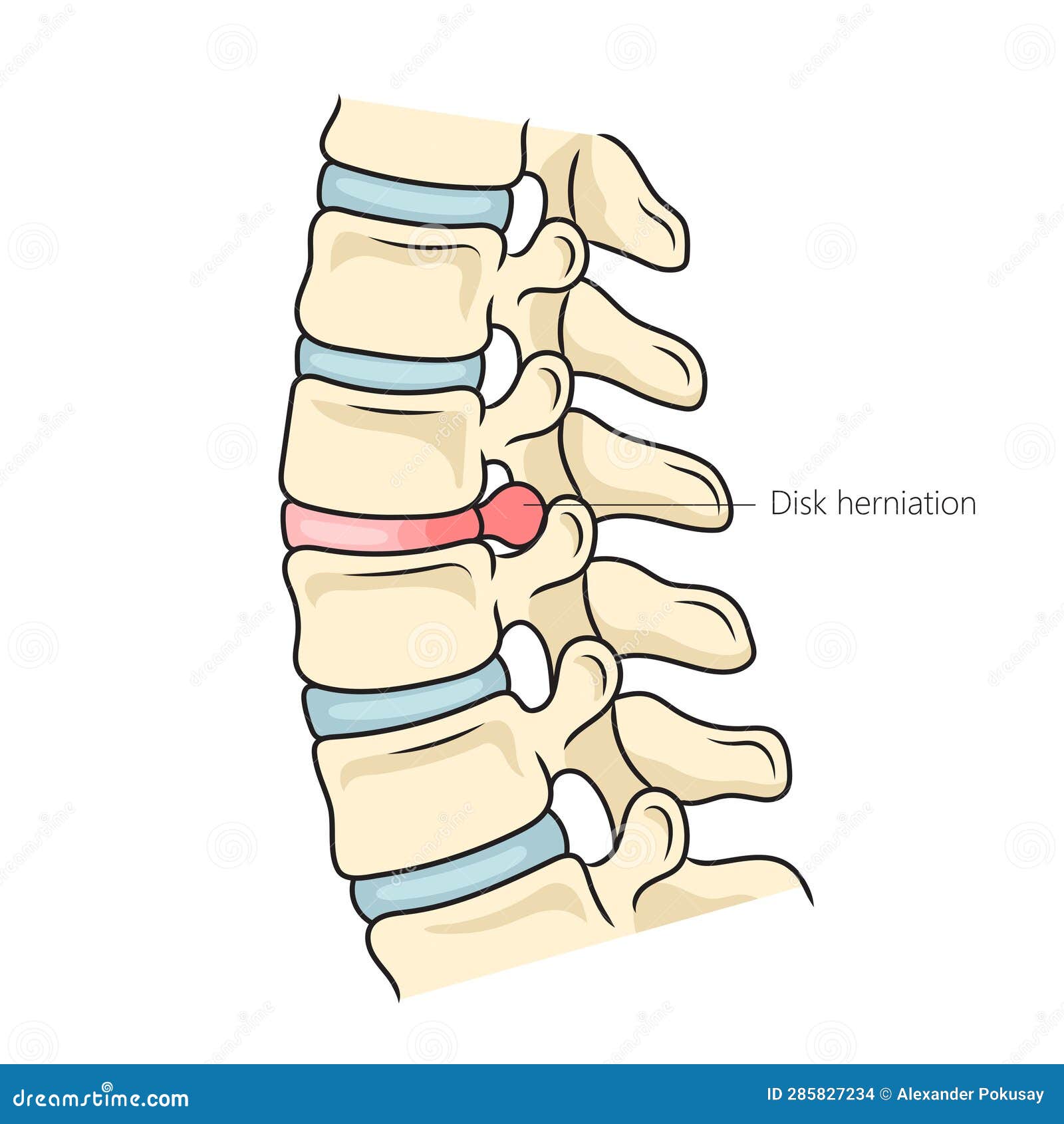 Spinal Disc Herniation Diagram Medical Science Vector Illustration ...