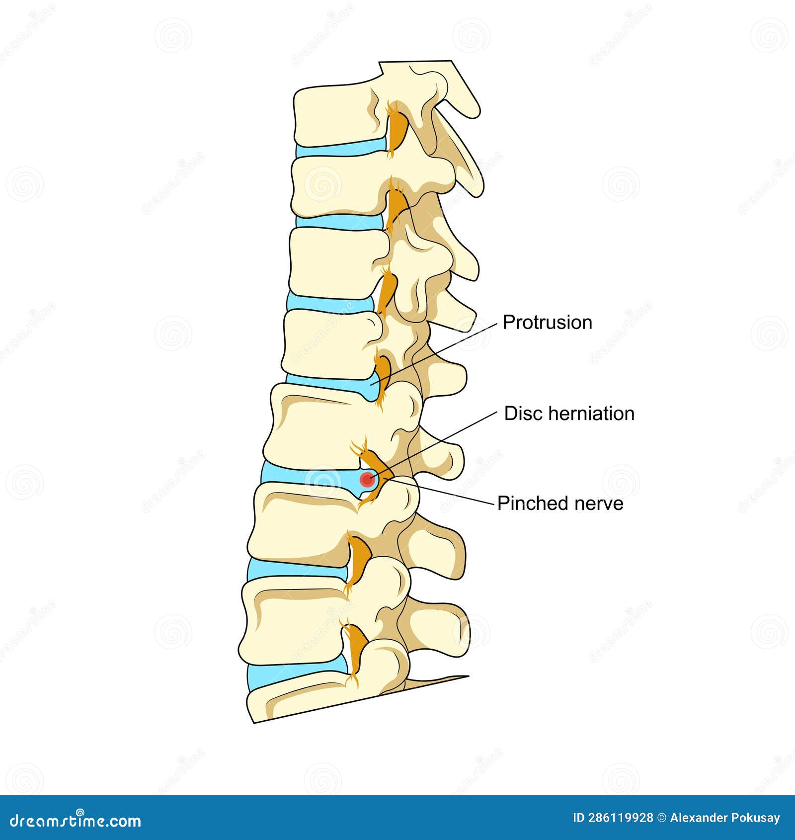 Spinal Disc Herniation Diagram Medical Science Stock Vector ...