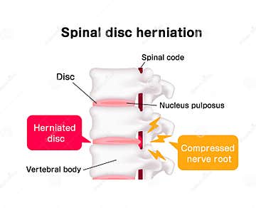 Spinal Disc Herniation Illustration Stock Vector - Illustration of ...