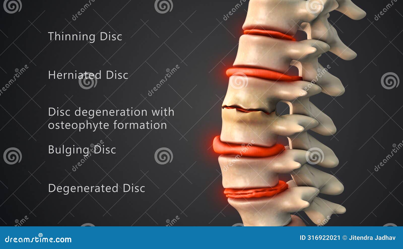 Difficulties with the Human Spinal Discs Stock Image - Image of ...