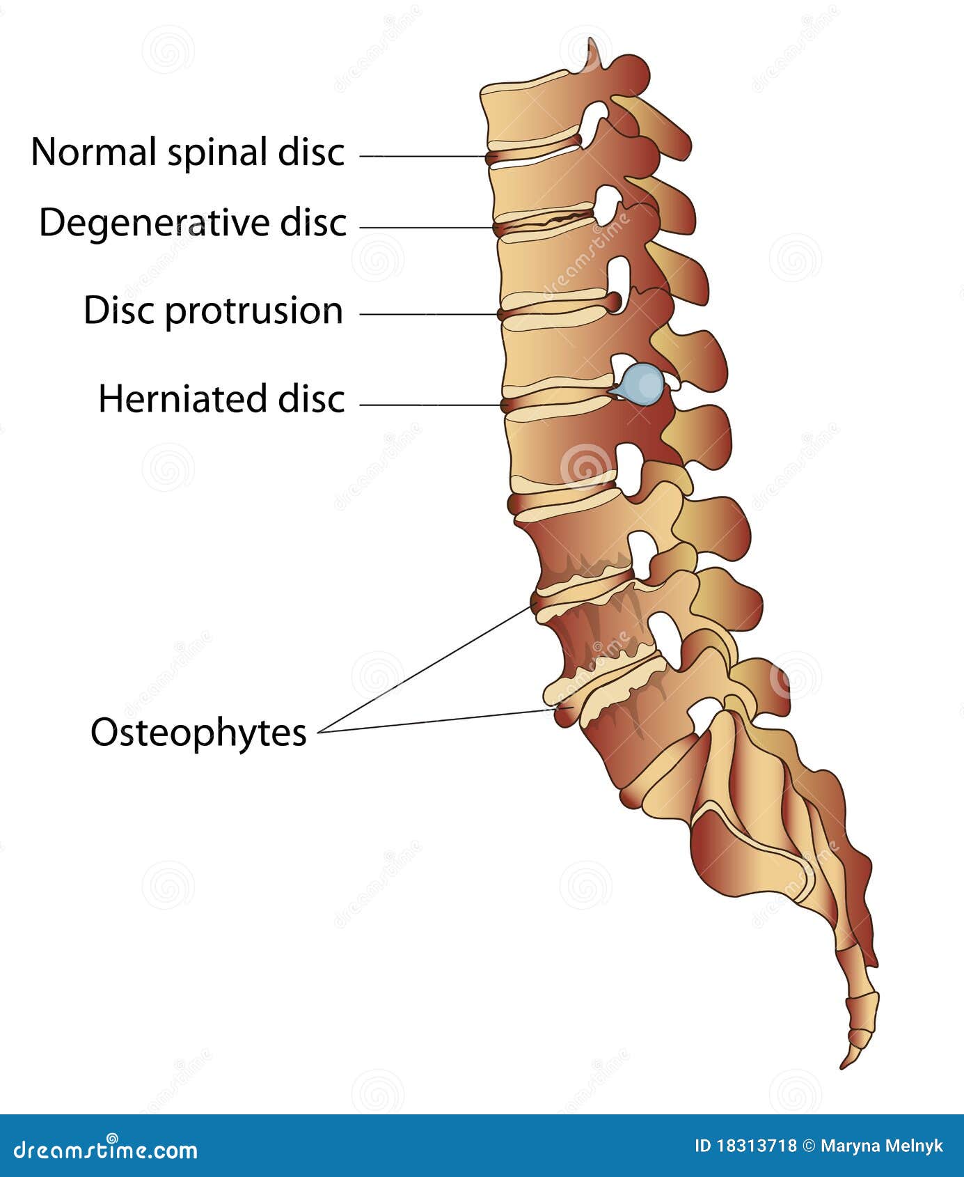 Spinal diseases stock vector. Illustration of neck, lumbar - 18313718