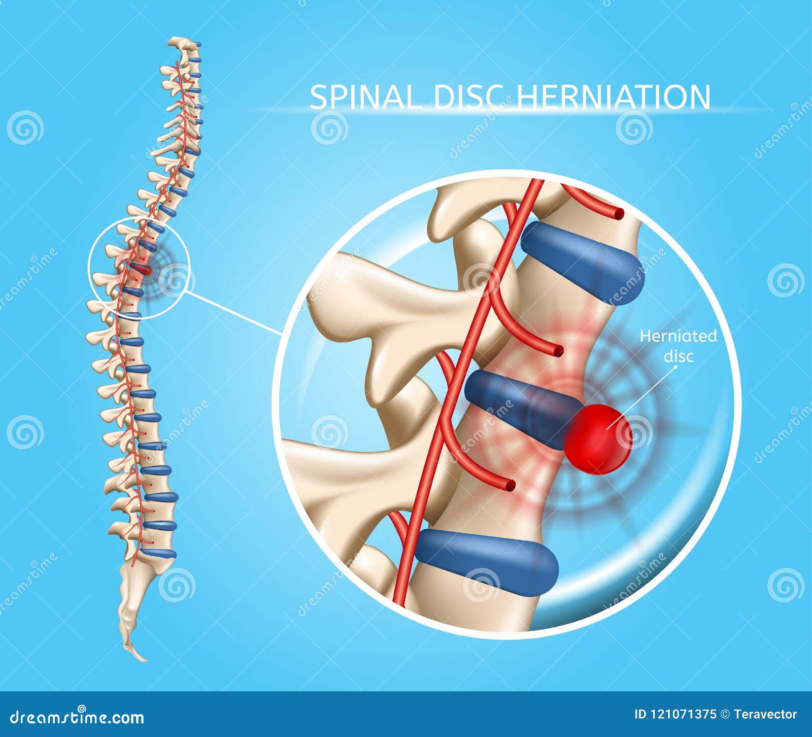 Spinal Disc Herniation Stock Vector Illustration Of Lumbar Hot Sex
