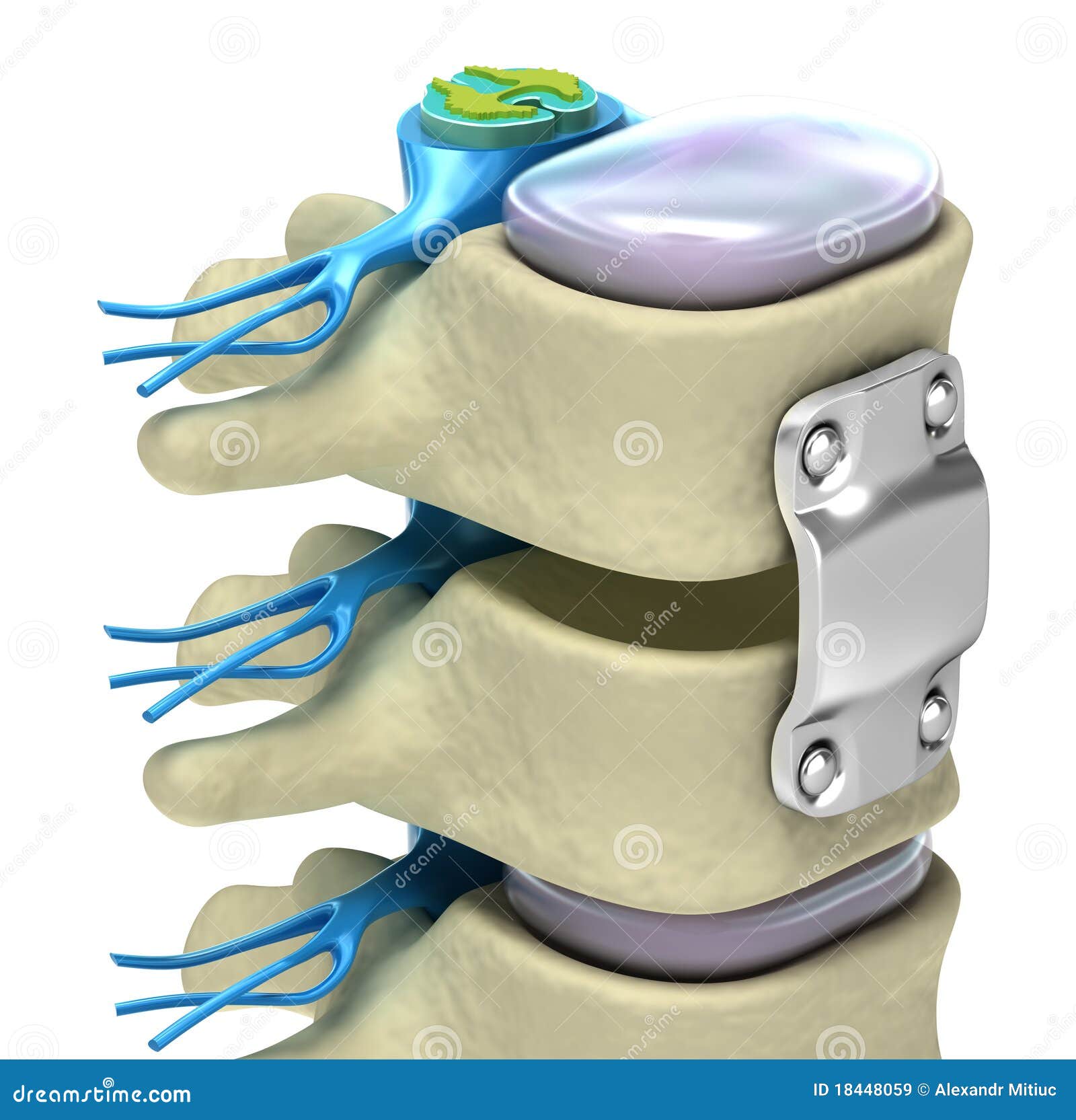 Spinal Fixation System - Titanium Bracket Stock Illustration ...