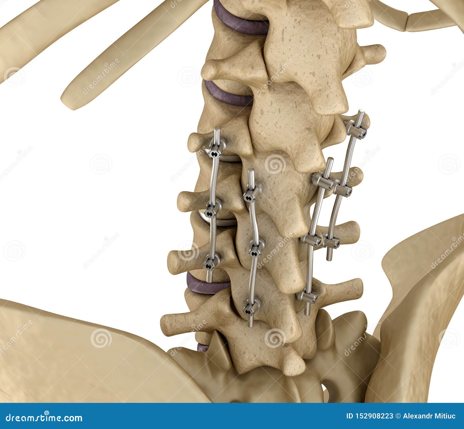 Spinal Fixation System - Titanium Bracket. Medically Accurate Stock ...