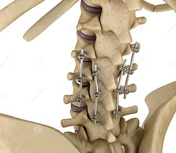 Spinal Fixation System - Titanium Bracket. Medically Accurate Stock ...