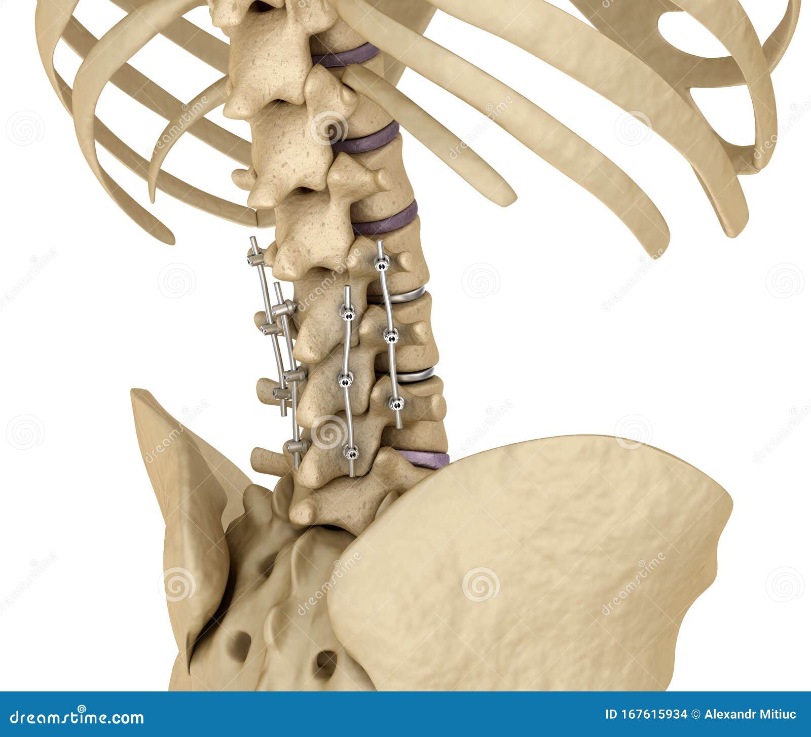 Spinal Fixation System - Titanium Bracket. Stock Illustration ...