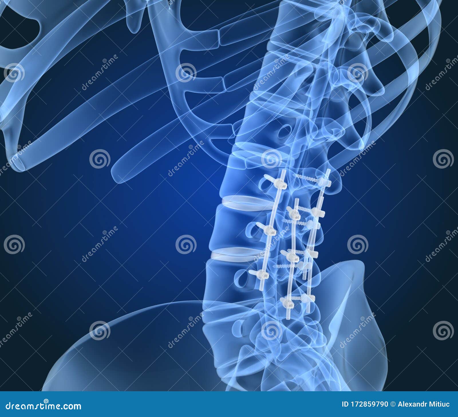 Spinal Fixation System - Titanium Bracket. X-ray View Stock ...