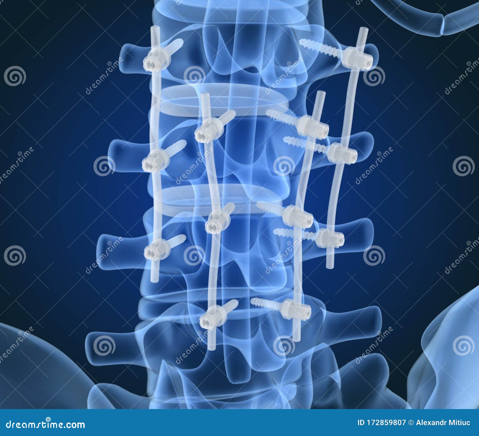 Spinal Fixation System - Titanium Bracket. X-ray View Stock ...