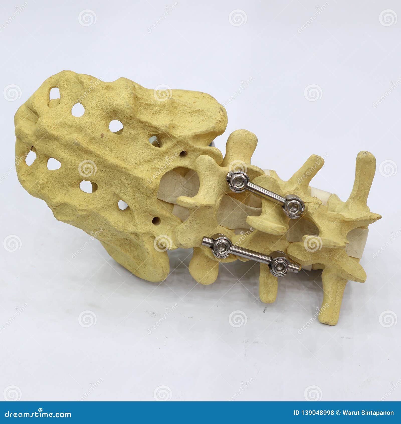 Spinal Fixation System - Titanium Bracket Stock Photo - Image of ...