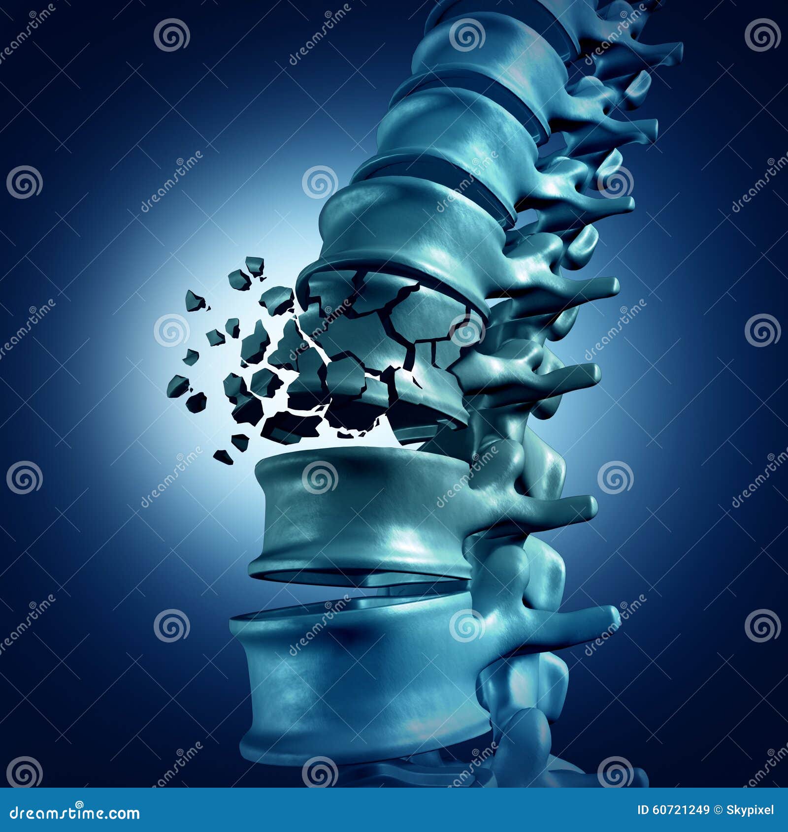 Spinal Fracture stock illustration. Illustration of compression - 60721249 Spinal Fracture stock illustration. Illustration of compression - 60721249