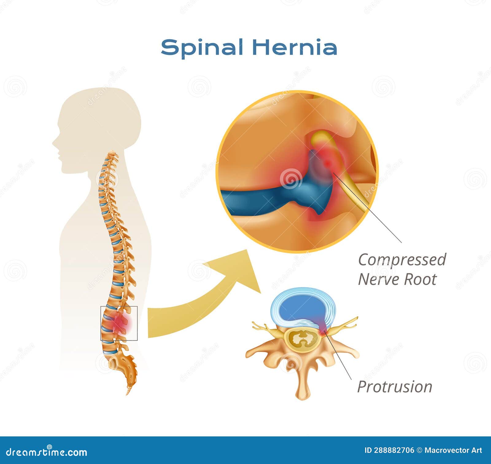 Spinal Hernia Anatomy Infographics Stock Vector - Illustration of root ... Spinal Hernia Anatomy Infographics Stock Vector - Illustration of root ...