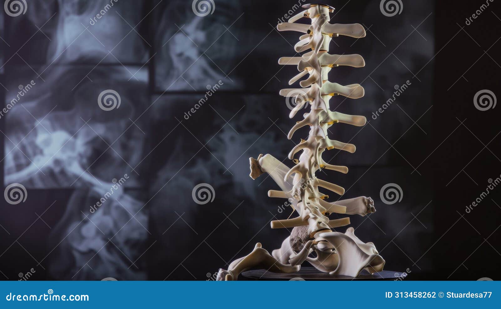 Spinal Model and X-rays Backdrop Stock Photo - Image of diagnosis ...