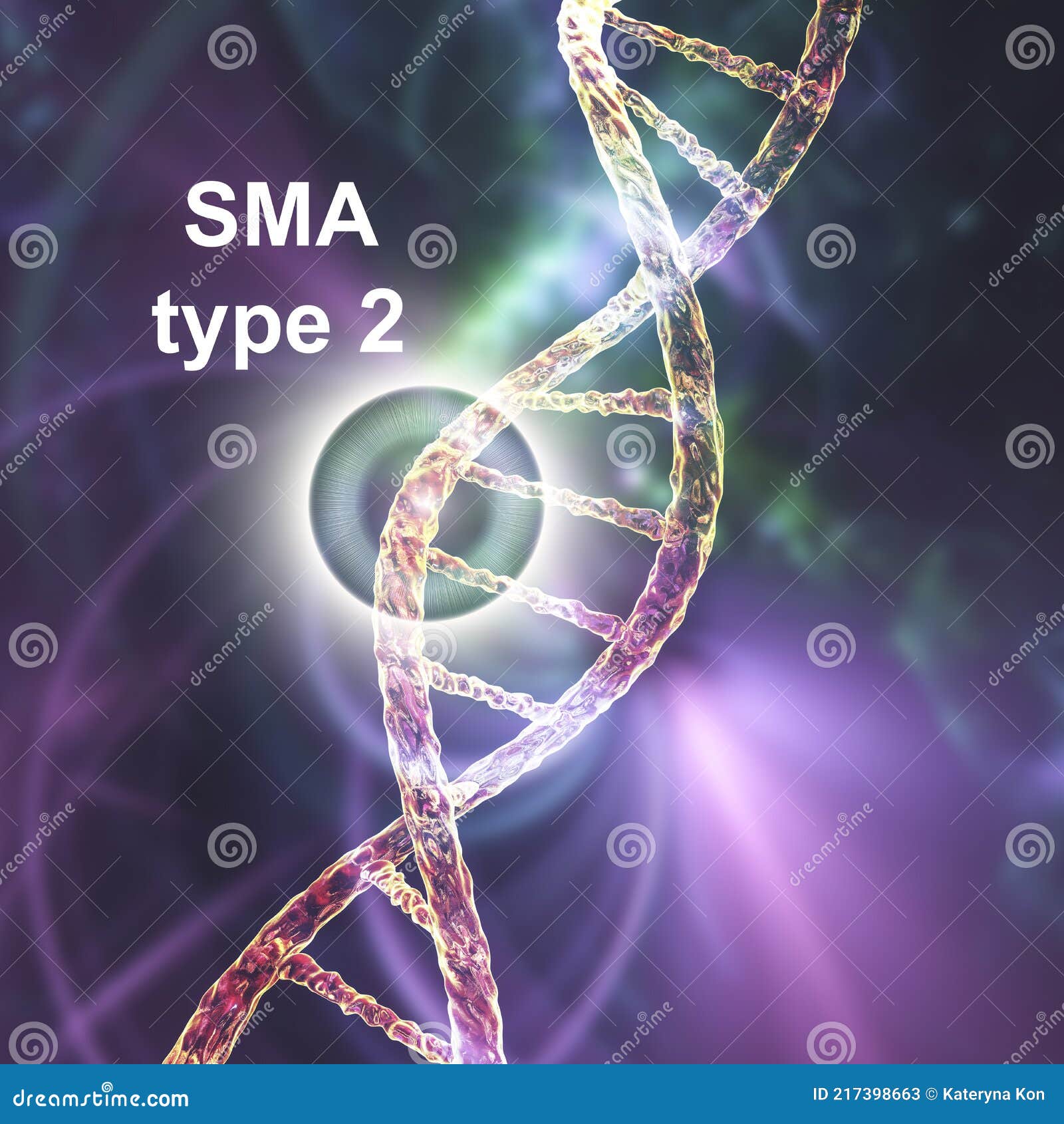Spinal Muscular Atrophy Sma A Genetic Neuromuscular Disorder Stock
