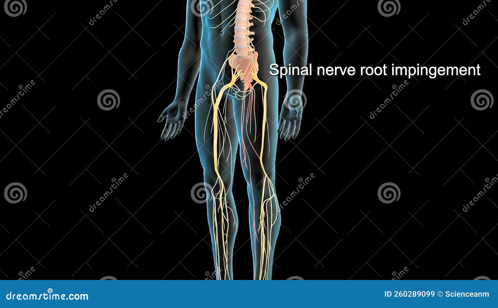 Spinal Nerve Root Impingement - 3D Illustration Stock Illustration ...