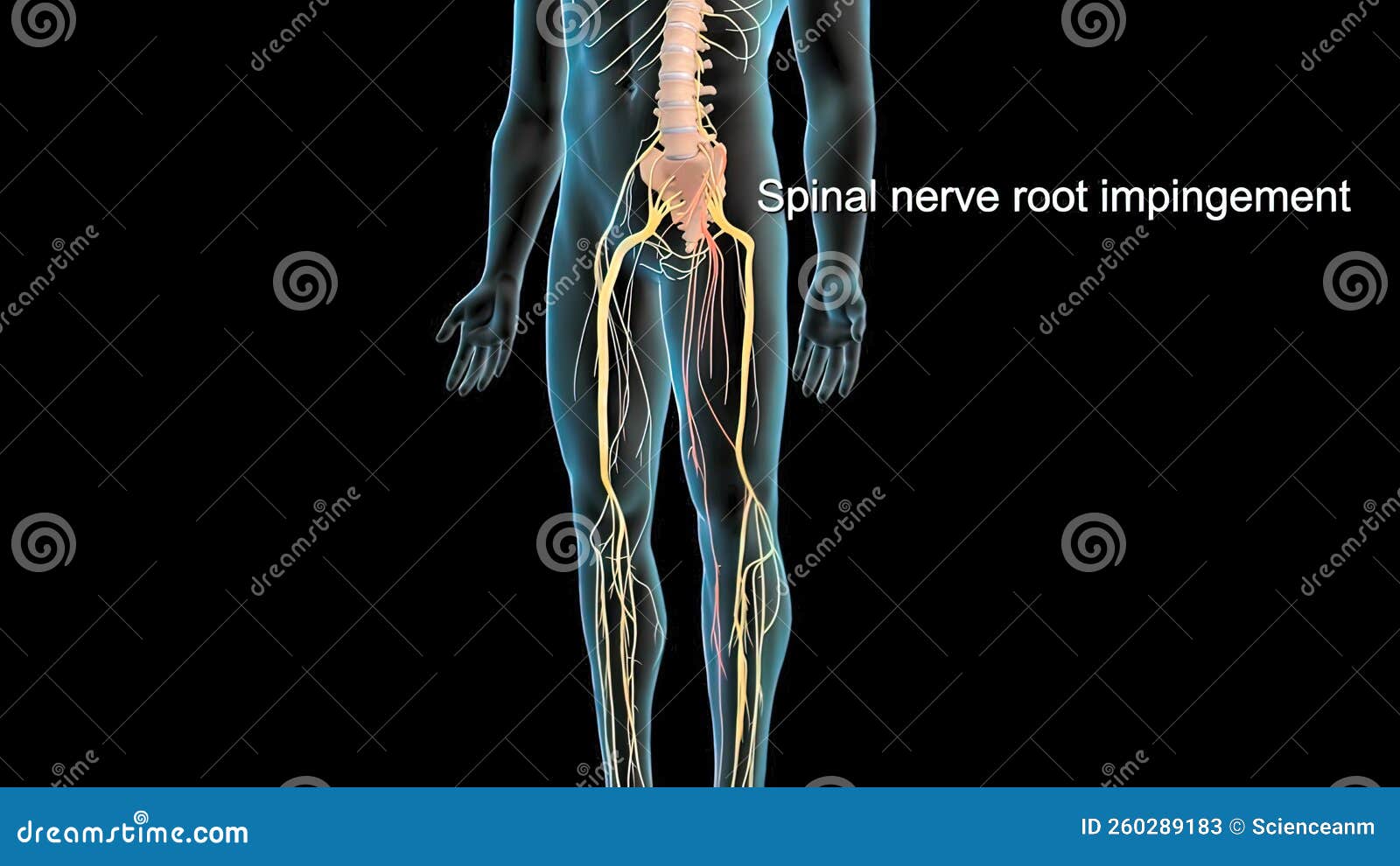 Spinal Nerve Root Impingement - 3D Illustration Stock Illustration ...