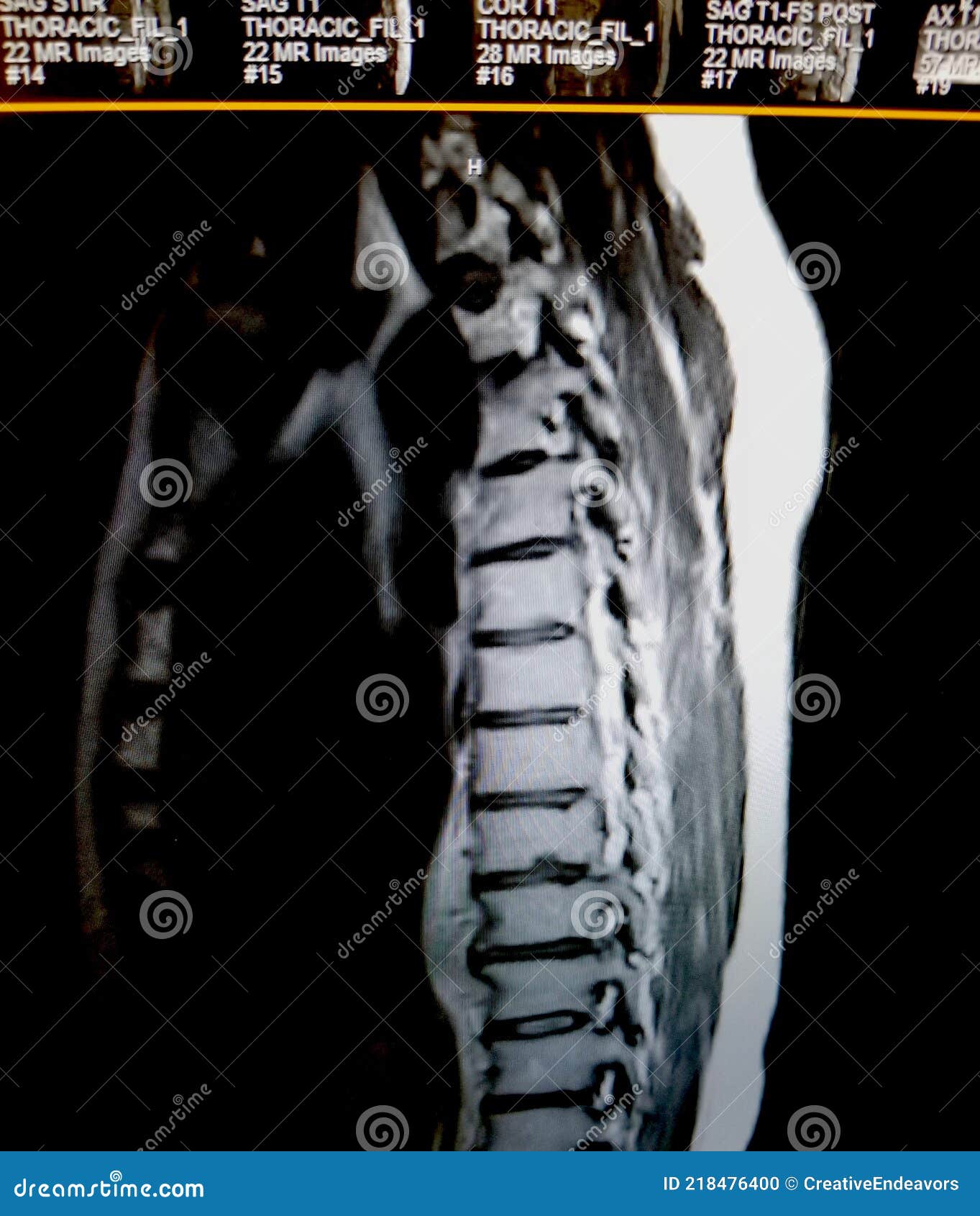 Prevertebral Phlegmon Stock Photos - Free & Royalty-Free Stock Photos ...