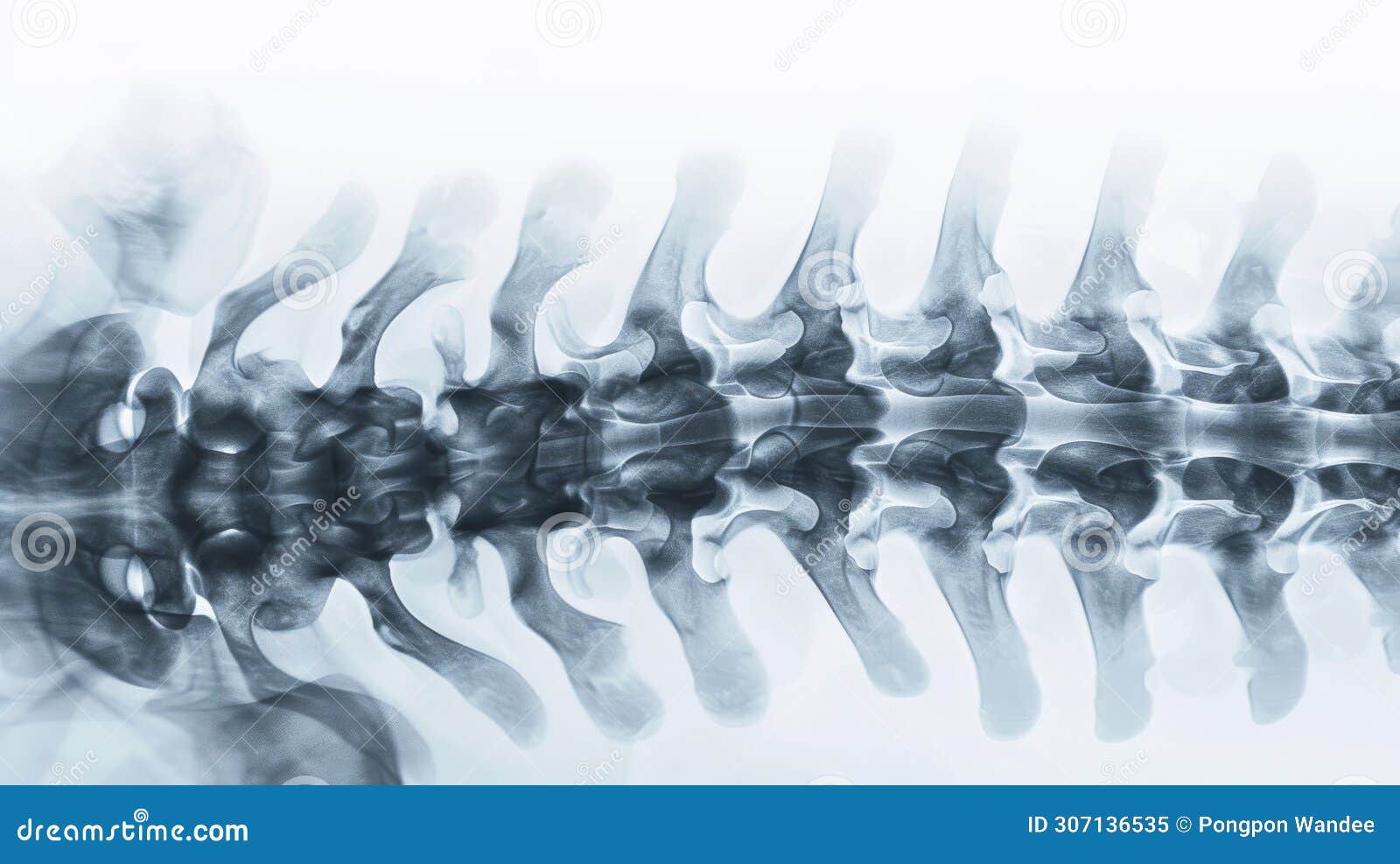Spinal X-ray Showing Cervical, Thoracic, and Lumbosacral Vertebrae ...