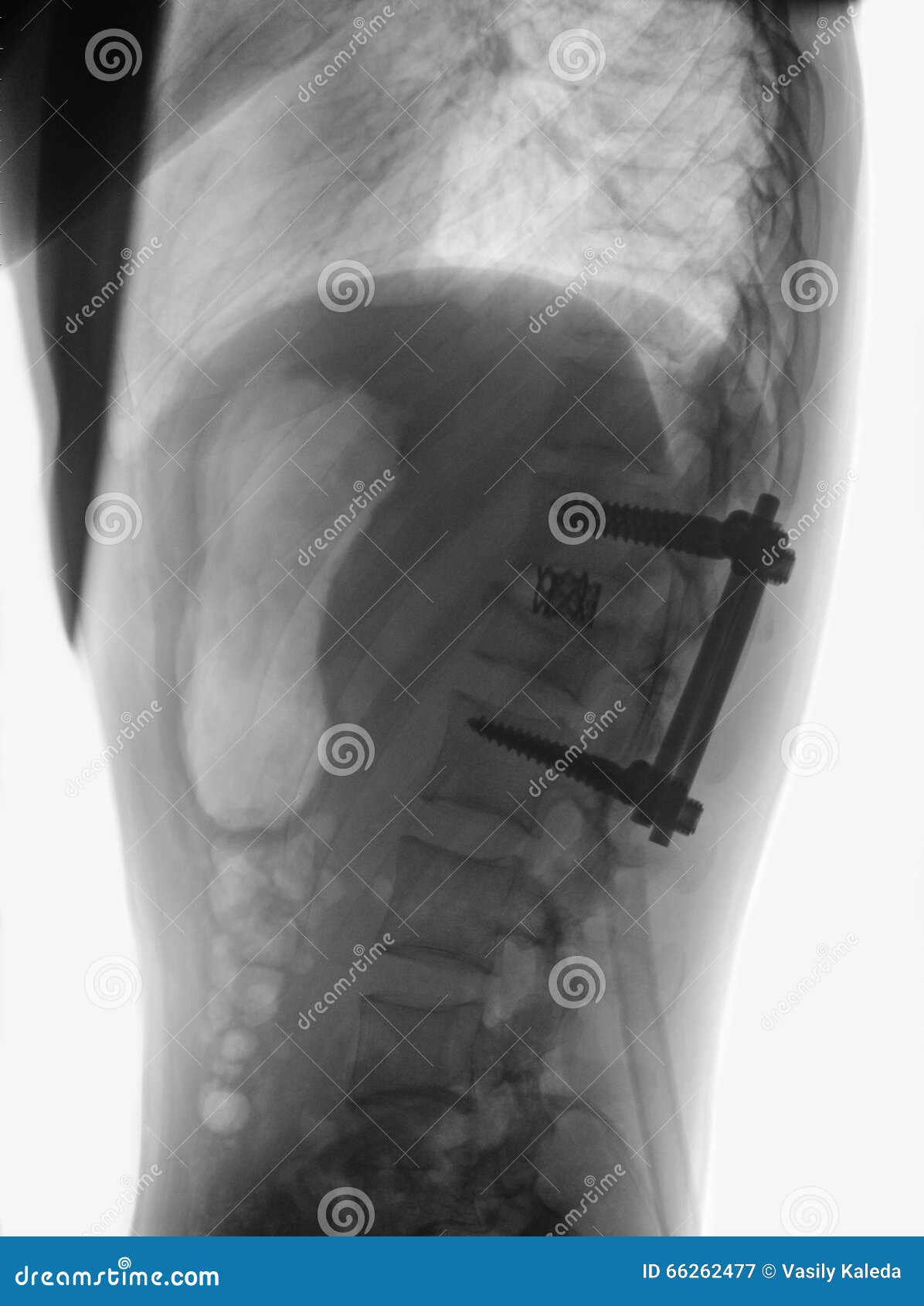 Spinal surgery stock image. Image of roentgenogram, prosthetic - 66262477