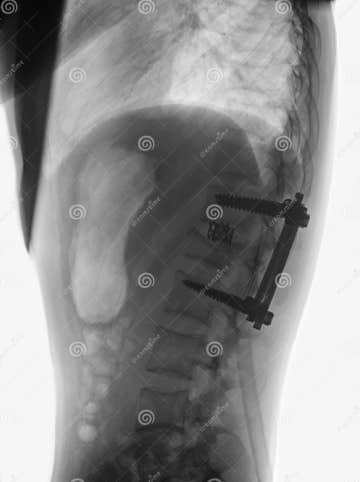 Spinal surgery stock image. Image of roentgenogram, prosthetic - 66262477