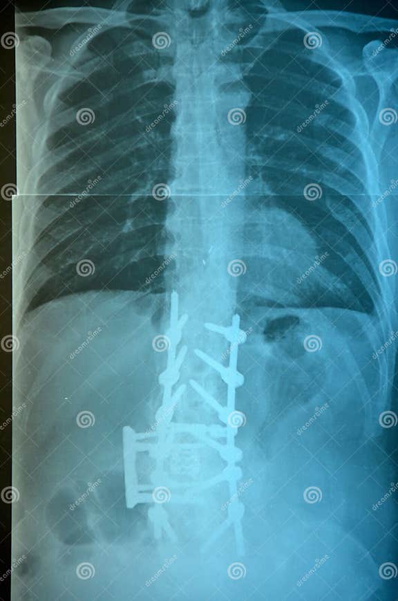 Spinal Surgery stock photo. Image of operation, handicapped - 263448818