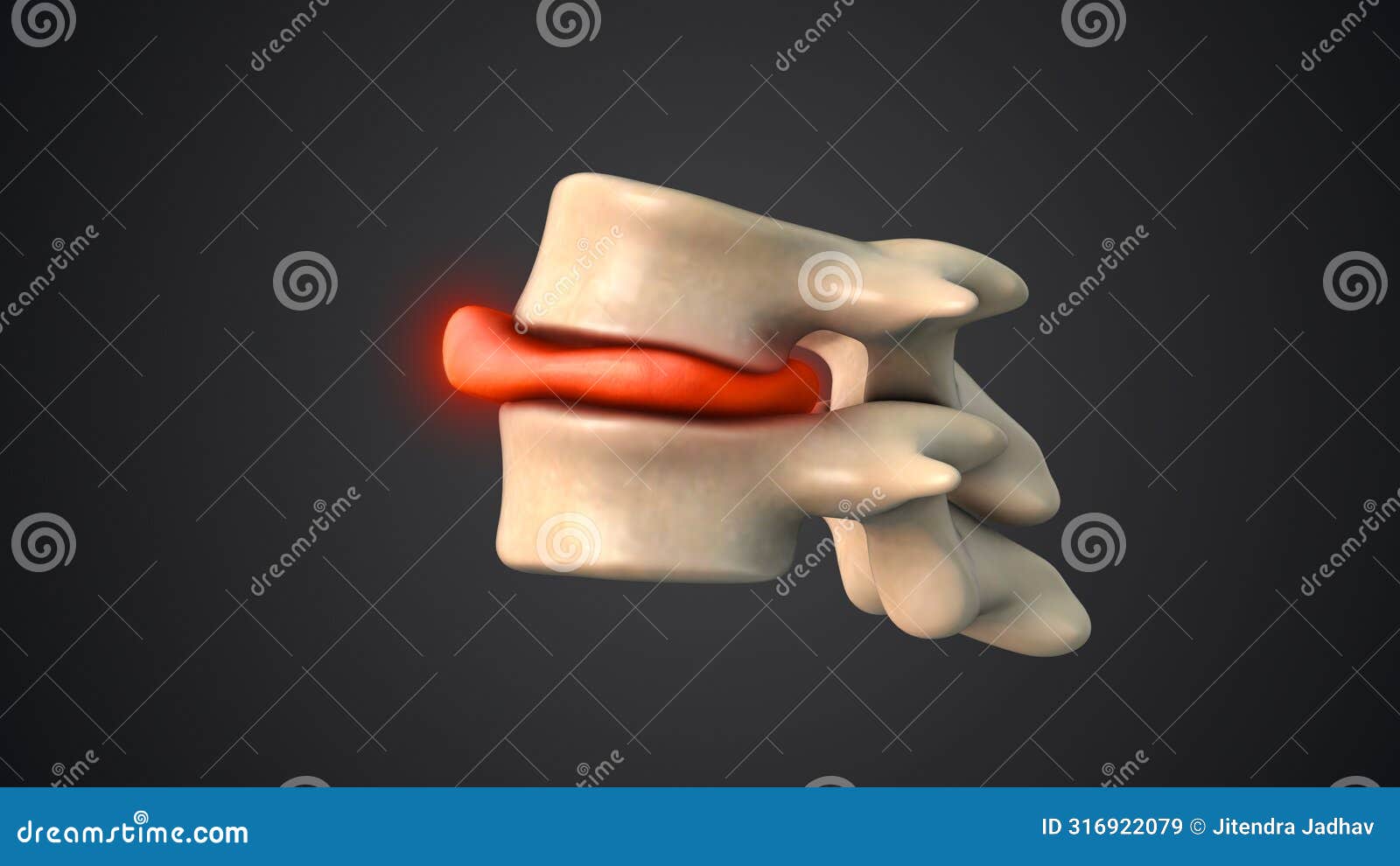 Spine Affected By A Bulging Disc Royalty-Free Stock Photo ...