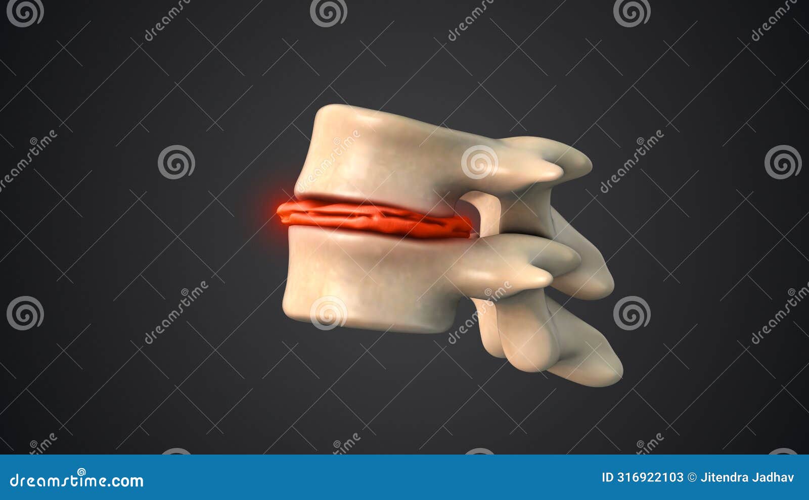 Spine Affected by a Degenerative Disc Stock Illustration - Illustration ...