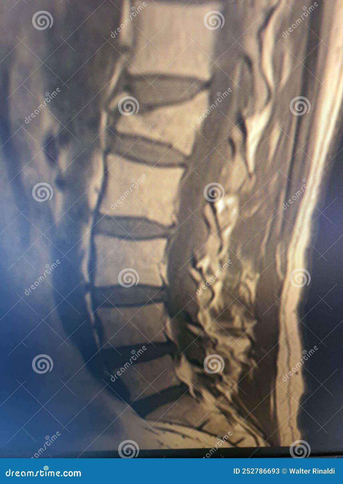 Spine with Broken Vertebrae. Xray Back Risonanza Stock Image - Image of ...