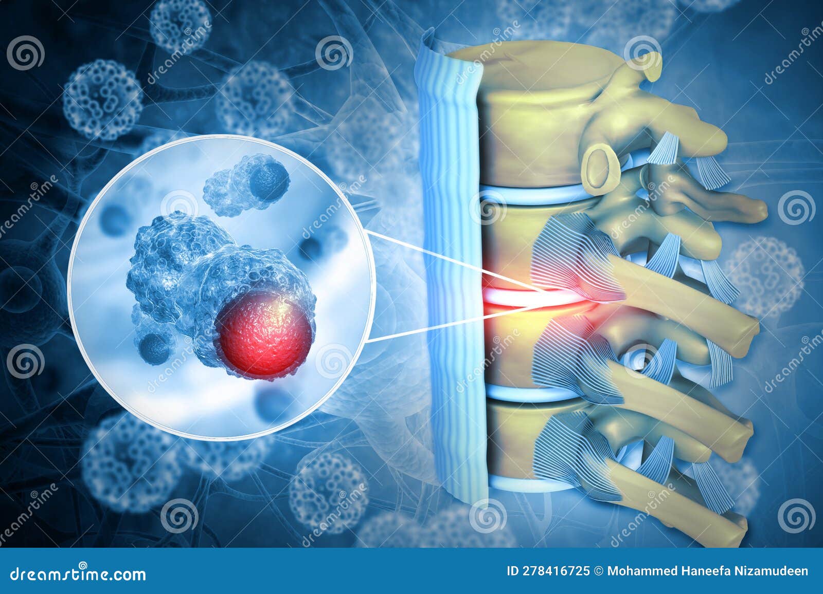 Spine Cancer or Spinal Tumor Disease Stock Illustration - Illustration ...