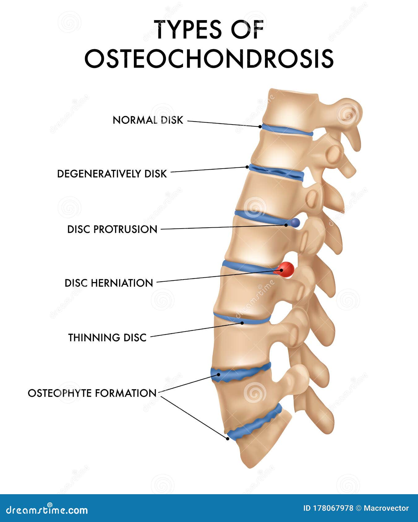 Spine Hernia Realistic Chart Stock Vector Illustration Of Disease