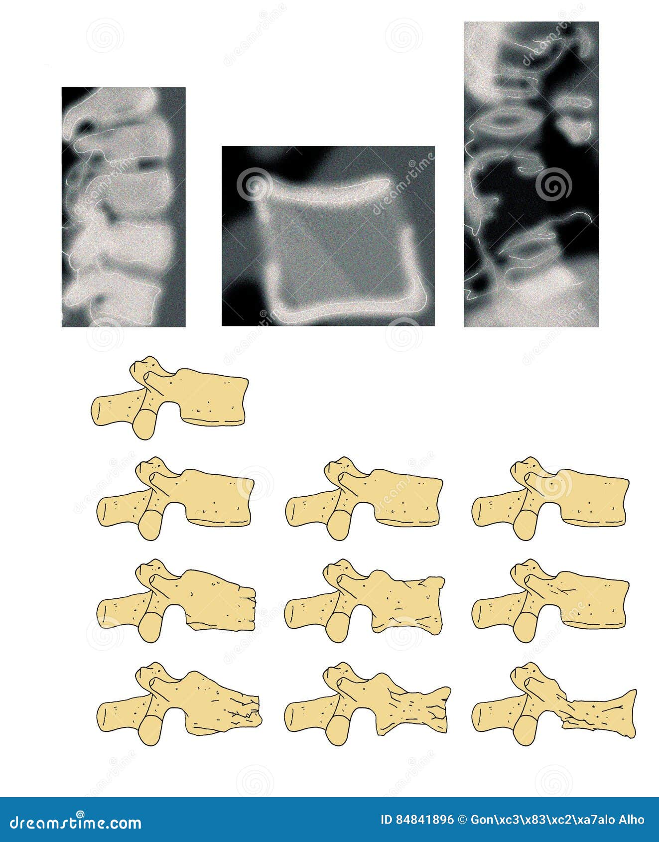 Spine illustration stock illustration. Illustration of anatomical ...