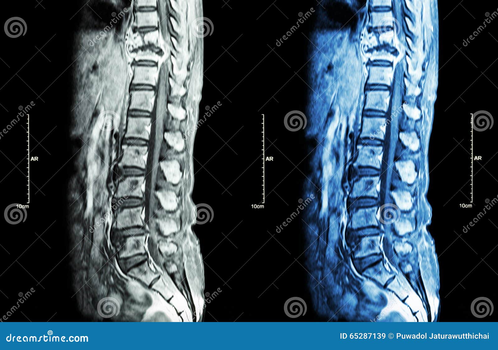 Spine Metastasis Cancer Spread To Thoracic Spine Mri Of Thoracic And Lumbar Spine Show