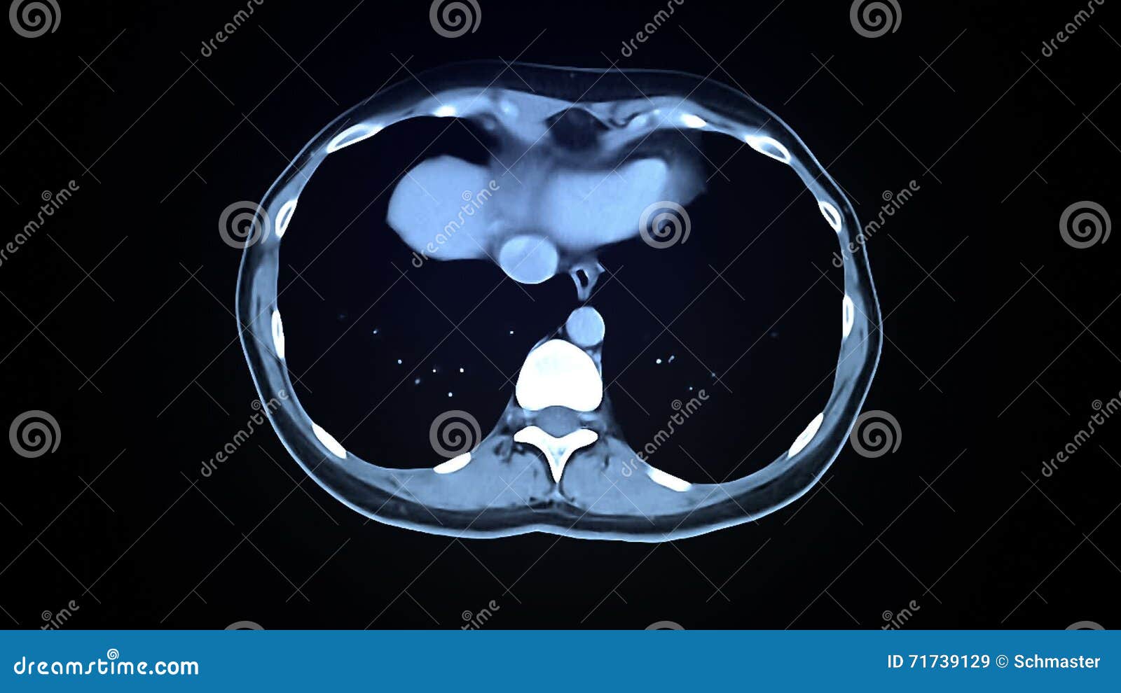 Spine MRI Scan stock video. Video of looking, examination - 71739129