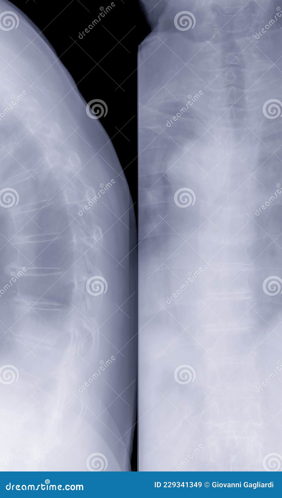 Spine and Pelvis of a Human Body on X-ray. Two Different Split Views ...