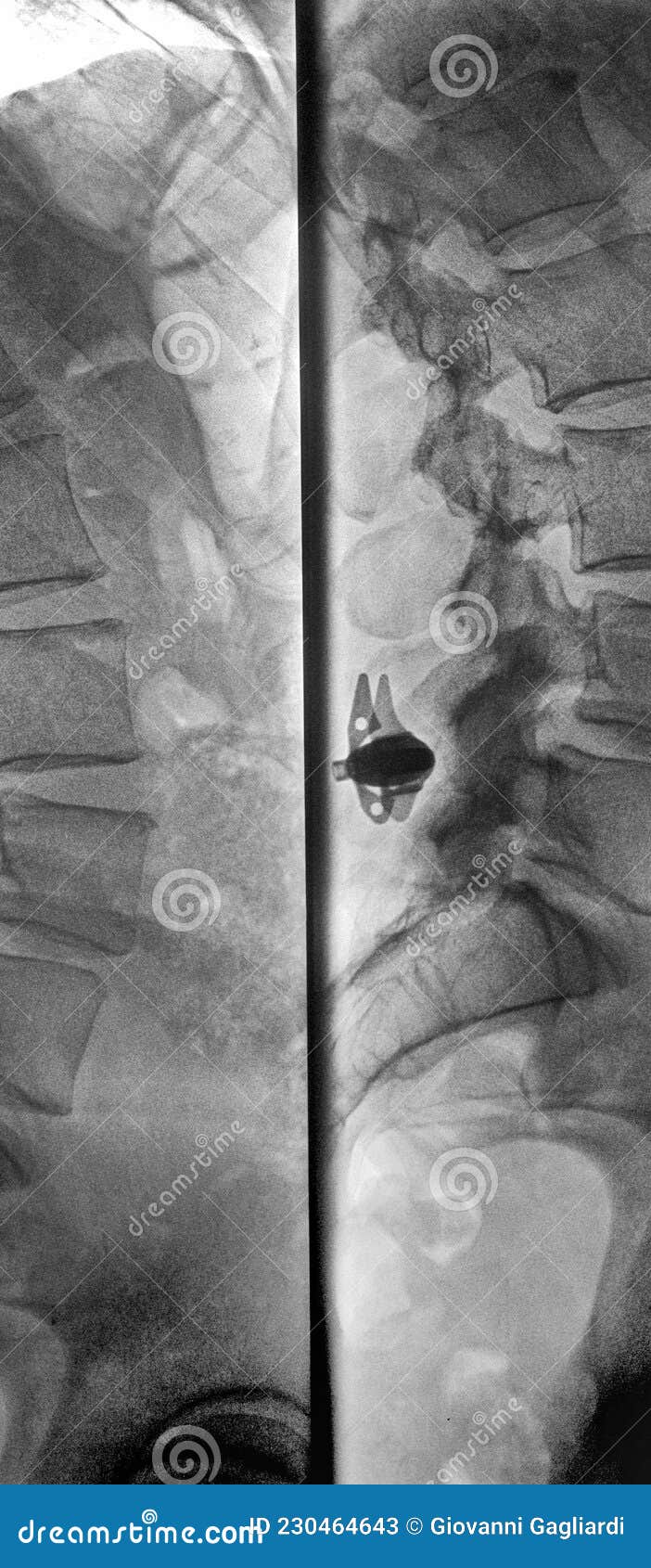 Spine And Pelvis Of A Human Body On X-ray. Two Different Split Views ...