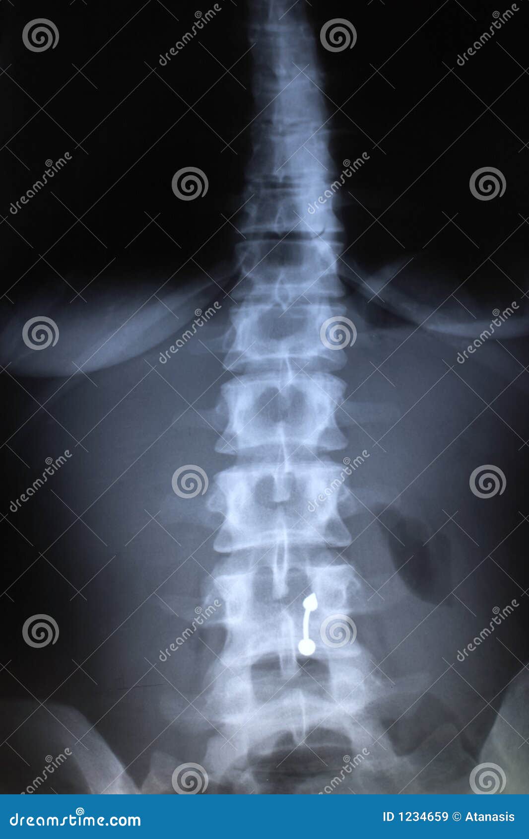 Spine Radiography - X Rays stock image. Image of pectorals - 1234659