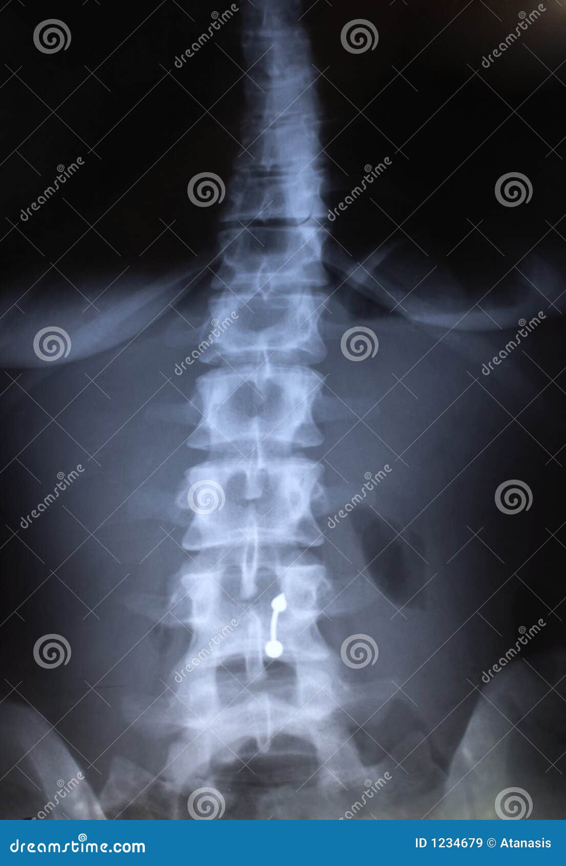 Spine Radiography - X Rays Royalty-Free Stock Photography ...